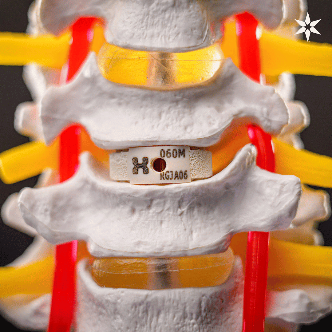 Two minds, one mission: Beacon surgeon and ND engineer advance spinal ...
